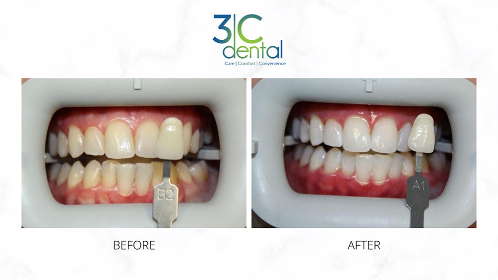 Whiter Smile | How Teeth Whitening Can Brighten Your Smile